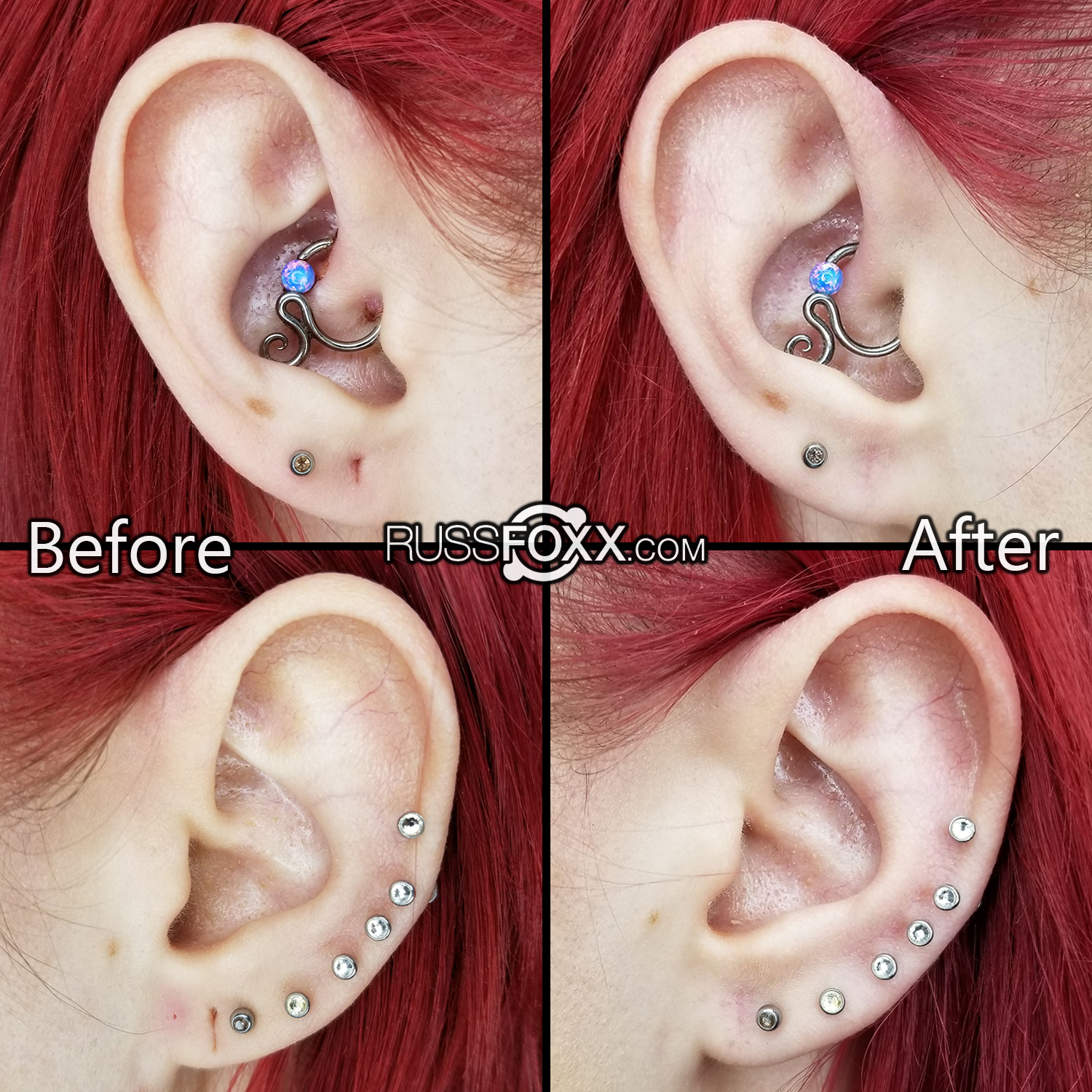 Petra’s Scar Reduction/Lobe Reconstruction – Russ Foxx