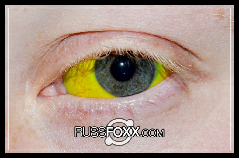 Scleral Staining – Russ Foxx